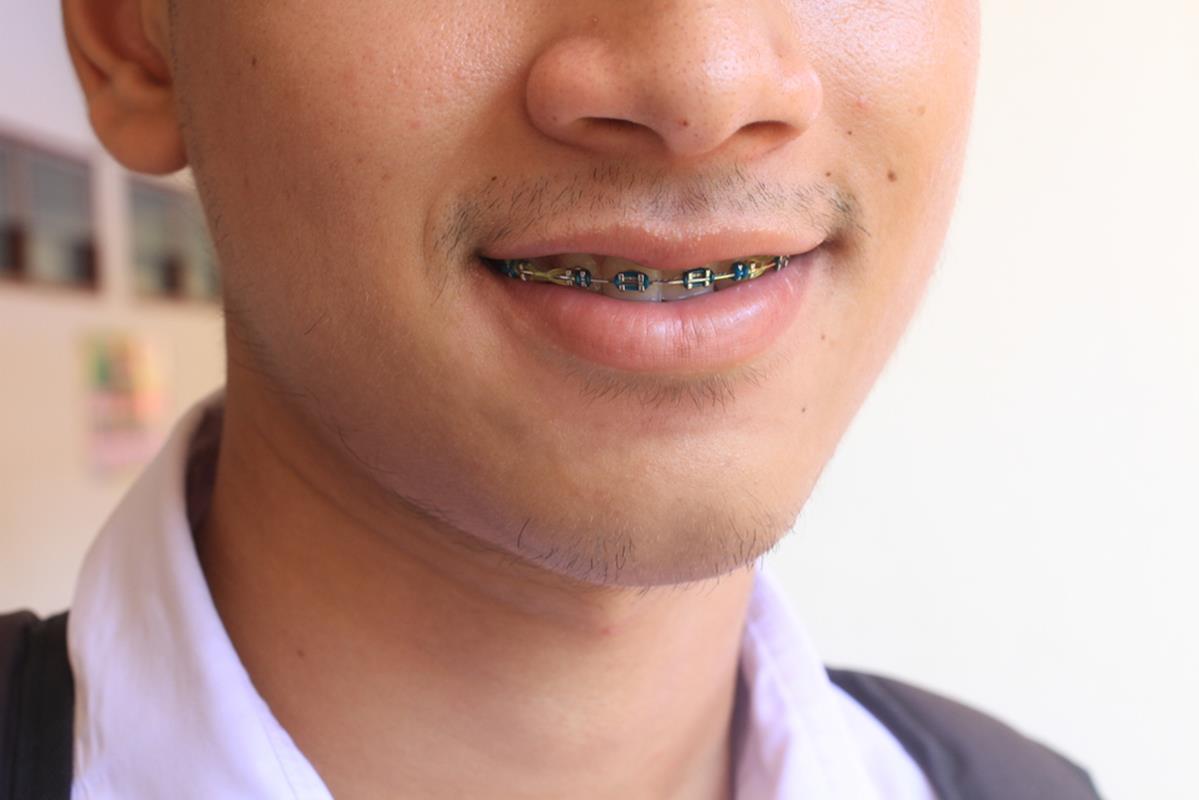 3 Common Types of Retainers | A&A Orthodontics